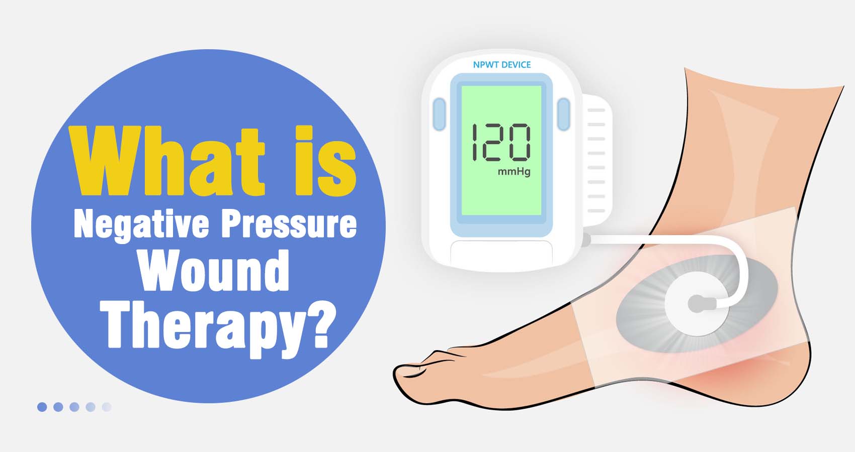 What is Negative Pressure Wound Therapy? - Conkote