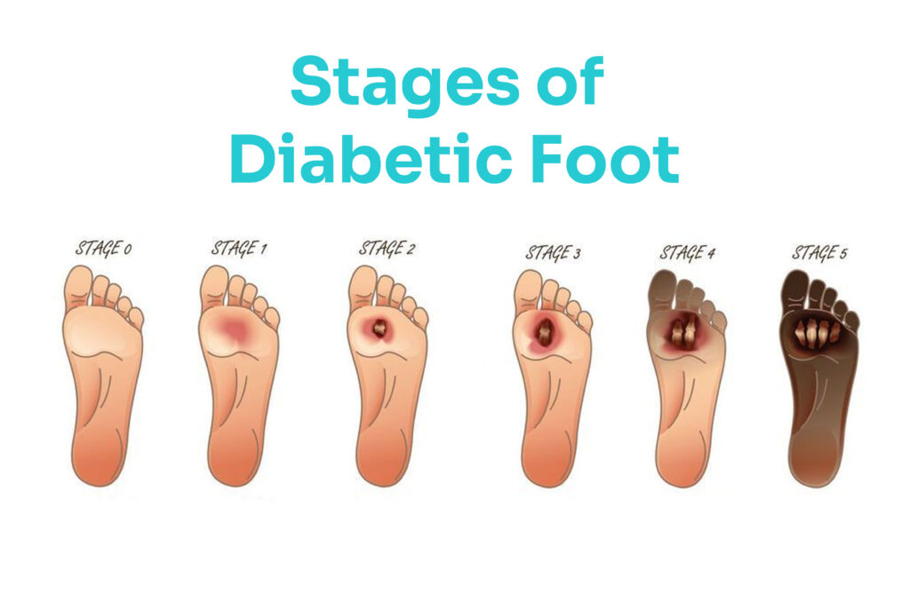 Diabetes & Foot Problems - Conkote
